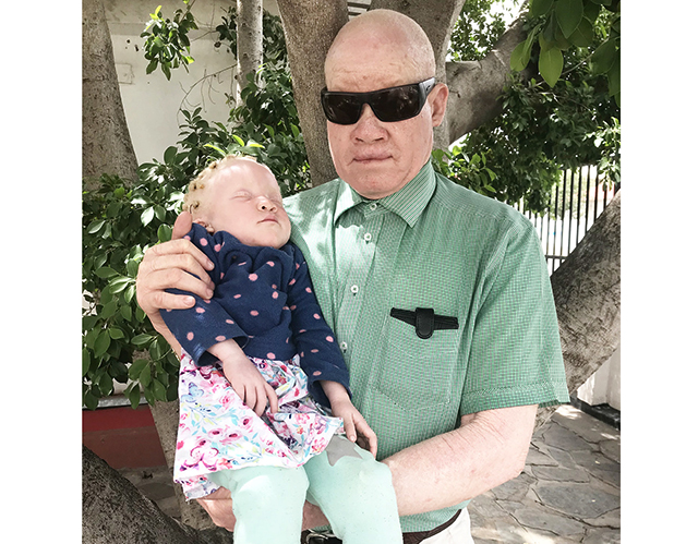 Little Maria seeks help to cope with albinism - The Namibian