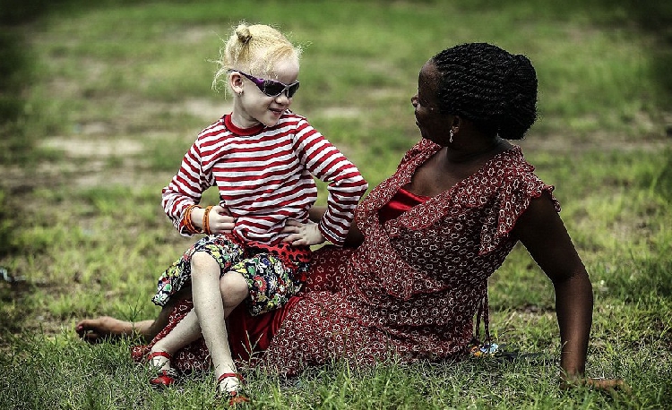New home for albinos living in Tanzanian refugee camp - The Namibian